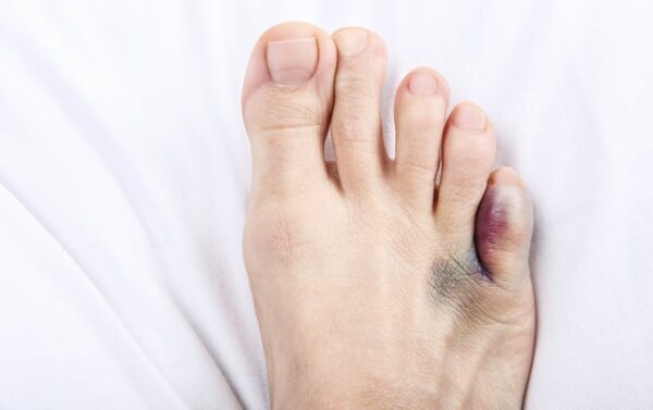 Can You Run With A Broken Toe? The Expert's Take