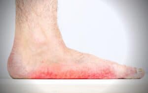 Running With Flat Feet + 8 Tips On How To Run With Flat Feet