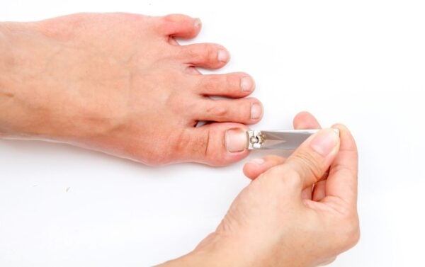 Blister Under Your Toenail? Here's How To Treat It