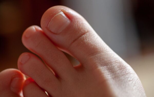 Blister Under Your Toenail? Here's How To Treat It