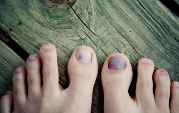 Blister Under Your Toenail? Here's How To Treat It