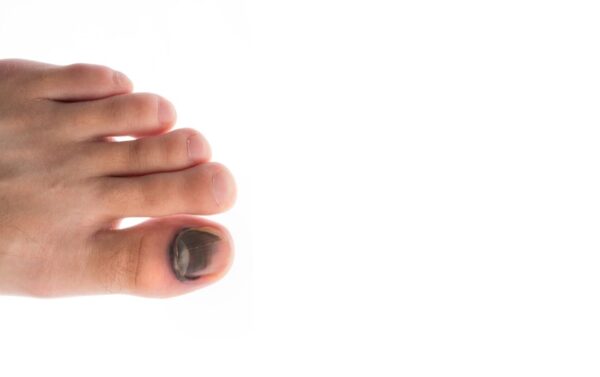 Runner's Toe: Causes, Symptoms, And Prevention