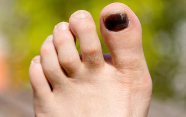 Runner's Toe: Causes, Symptoms, And Prevention