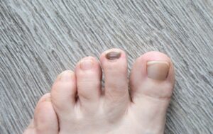 Runner's Toe: Causes, Symptoms, And Prevention