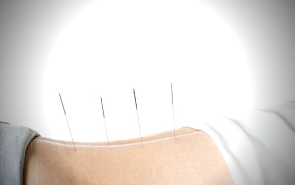 Acupuncture For Athletes: 7 Benefits + What To Expect