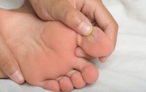 Chafing And Running: How To Prevent Chafing While Running