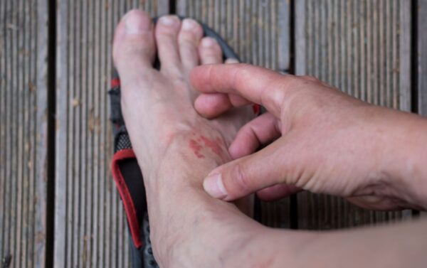 How To Help Chafing: The Complete Guide To Preventing + Healing It