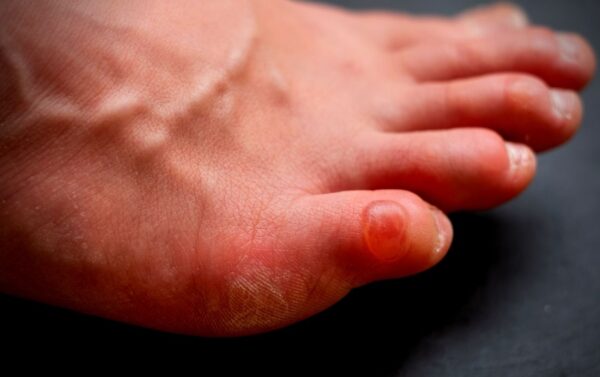 Here's How To Stop Your Pinky Toe Rubbing In Your Shoes