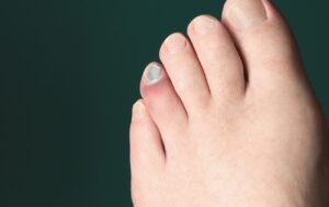 Stubbed Toe Treatment: When Do You Need To Seek Help?