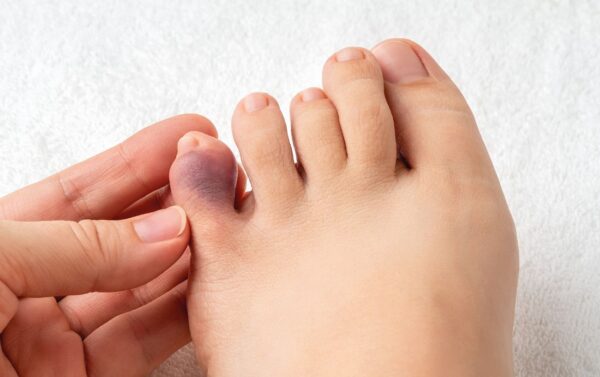Stubbed Toe Treatment: When Do You Need To Seek Help?