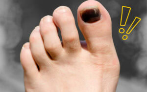 6 Ways To Stop A Toenail Falling Off From Running