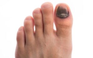 Why Runners' Toenails Fall Off + 4 Helpful Tips To Prevent It