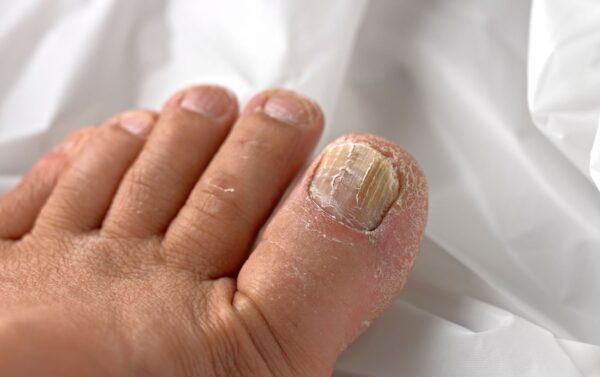 Why Runners' Toenails Fall Off + 4 Helpful Tips To Prevent It