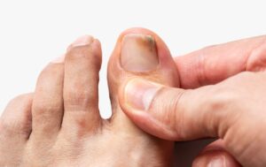 Why Runners' Toenails Fall Off + 4 Helpful Tips To Prevent It